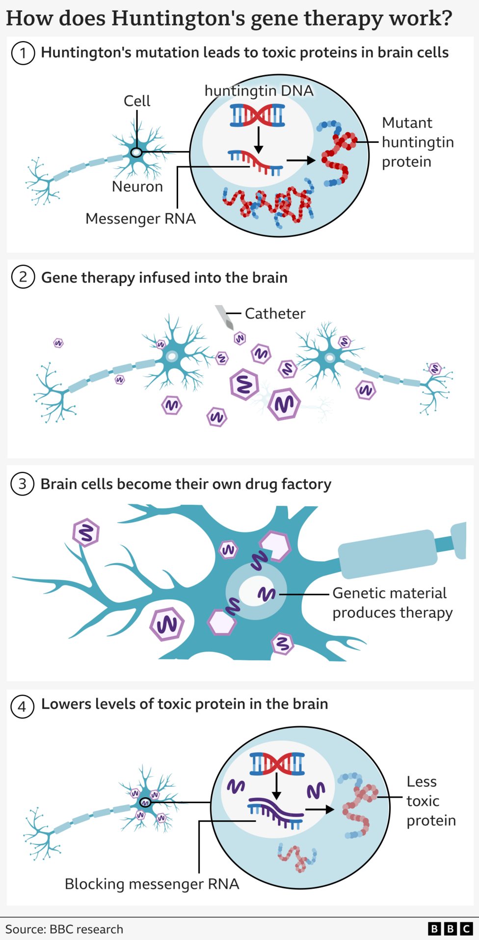Huntington's disease successfully treated for first time - BBC News