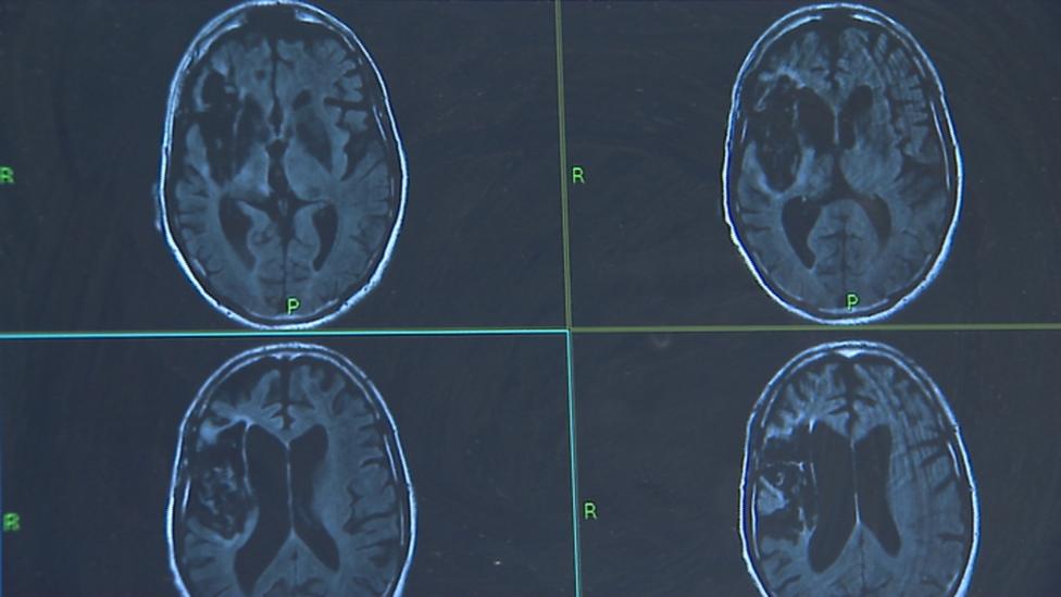 Microwave helmet 'can spot a stroke' - BBC News