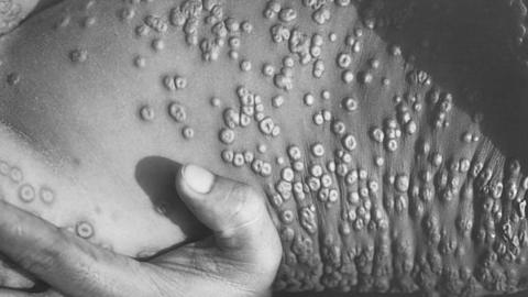 Viruela del mono: en qué se diferencia de la devastadora viruela humana ...
