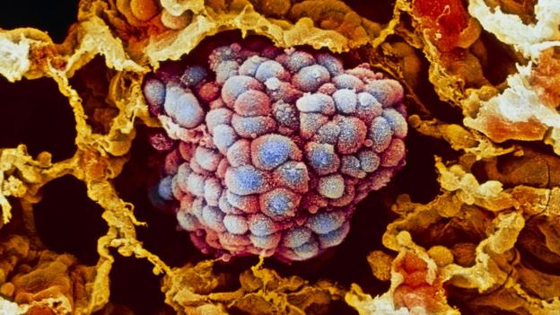 Coronavirus: cómo la tecnología ARNm puede abrir las puertas a una vacuna contra el cáncer - BBC ...