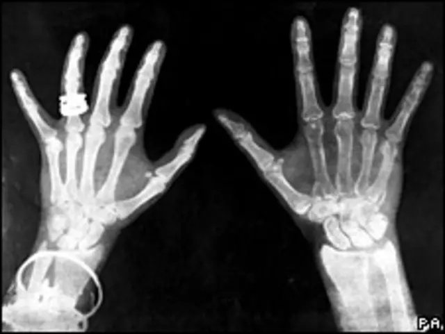 Máquina de rayos X, el mejor invento - BBC News Mundo