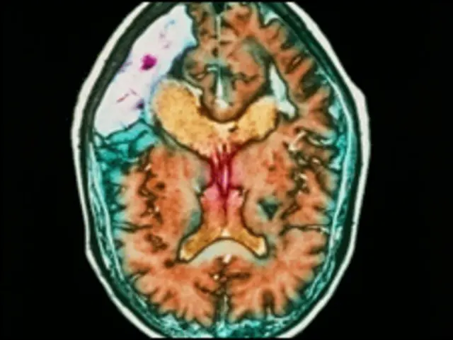 Enfriar el cerebro podría ayudar a recuperarse de un derrame - BBC News ...