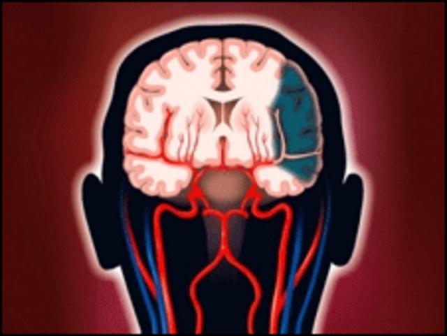 Enfriar el cerebro podría ayudar a recuperarse de un derrame - BBC News ...