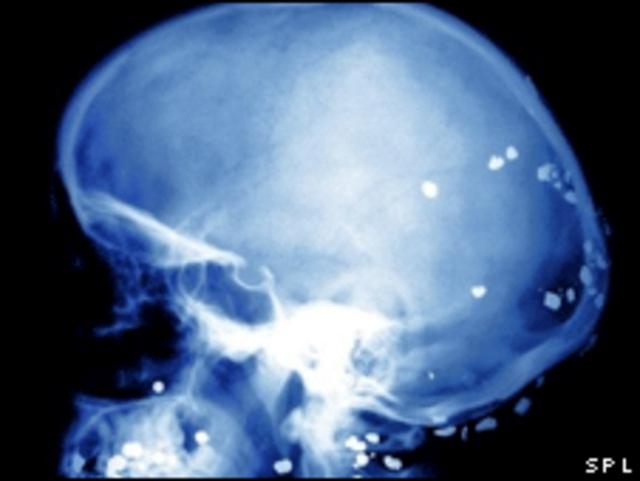 ¿Cómo se sobrevive a un tiro en la cabeza? - BBC News Mundo