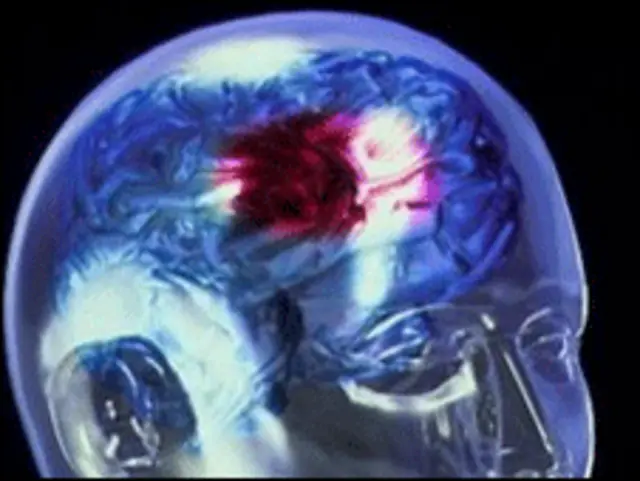 Especias para combatir los daños de derrame cerebral - BBC News Mundo