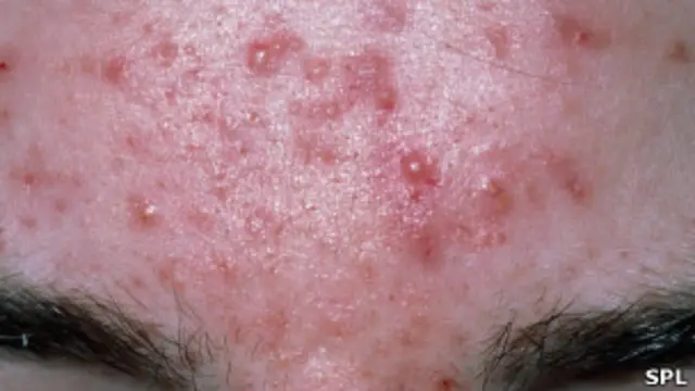 Un virus: esperanza contra el acné - BBC News Mundo