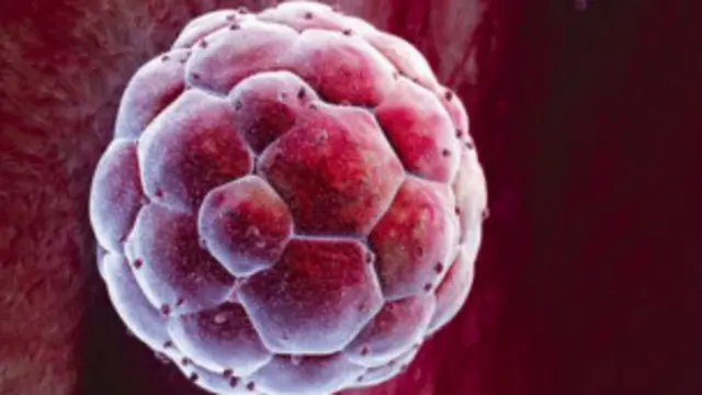 Pasien stroke 'membaik' pasca injeksi sel punca - BBC News Indonesia