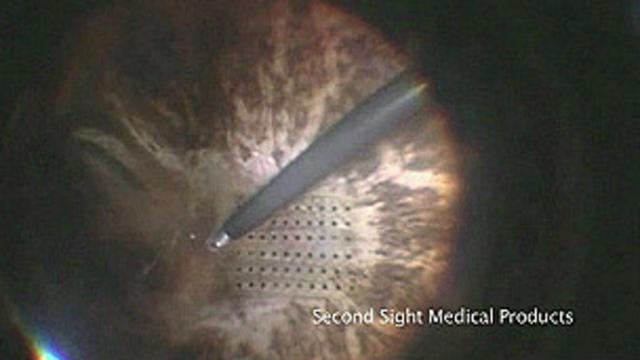Un mundo de ojos biónicos - BBC News Mundo