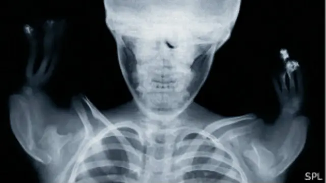 Talidomida: el peligroso medicamento que Brasil aún no prohíbe - BBC ...