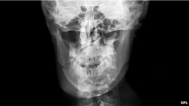 Los puñetazos marcaron la evolución del rostro masculino - BBC News Mundo