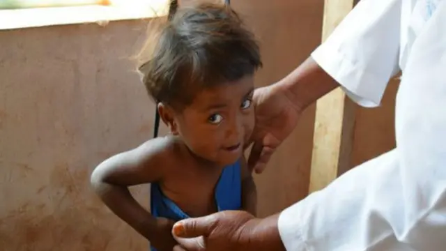 Especialistas tentam desvendar mistério das crianças 'atrofiadas' em ...