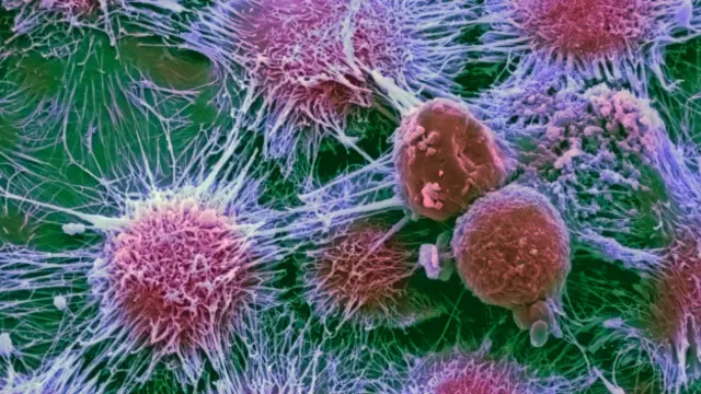 10 gráficos para entender el grave impacto del cáncer en el mundo - BBC ...