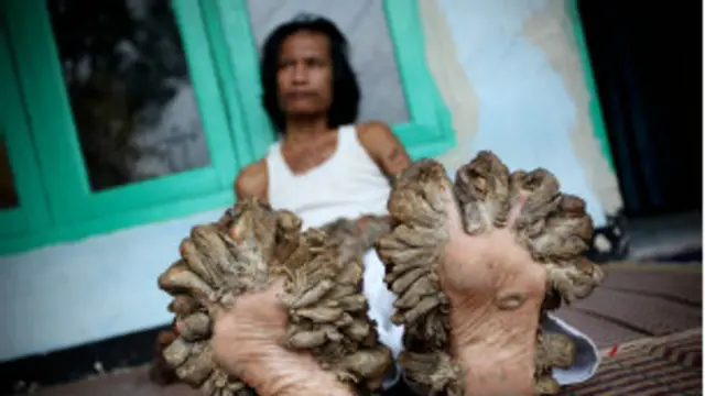 La extraña enfermedad del "hombre-árbol" de Bangladesh - BBC News Mundo