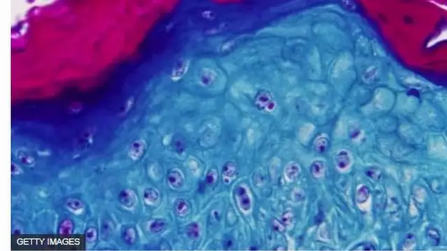 What to know about monkeypox: Ṣé lóòótọ́ ní pé àwọn òní ìbálòpọ̀ akọ sí ...