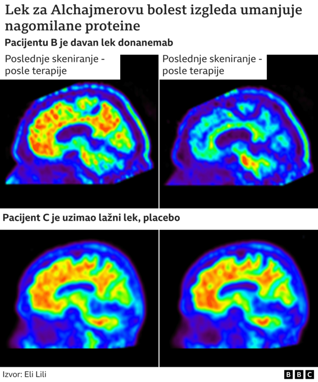 Medicina i demencija: Novi lek se smatra prekretnicom u borbi protiv ...