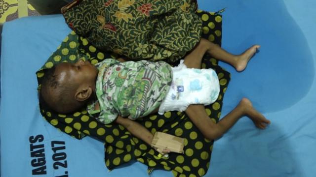 Melihat anak-anak di Asmat yang dilanda wabah campak dan gizi buruk - BBC News Indonesia