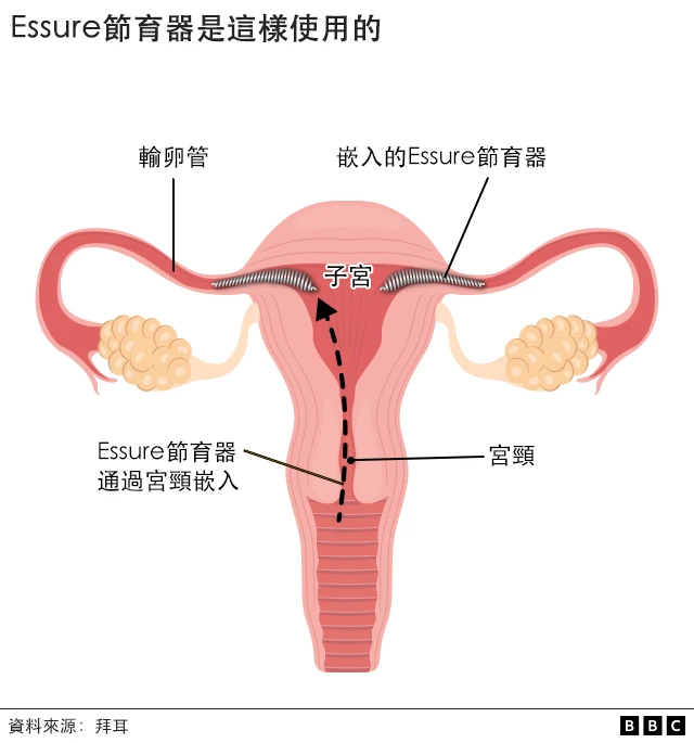 女性健康：Essure節育器副作用巨大，她們起訴製藥巨頭拜耳 - BBC News 中文