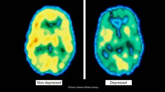 Images Of A Depressed Brain Brain SPECT Imaging Predicts Outcomes In