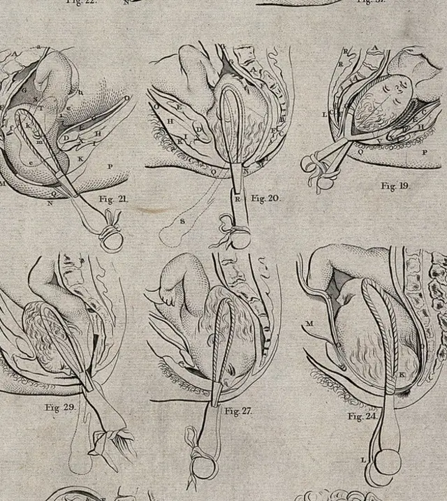La familia francesa que inventó los fórceps (y por qué lo mantuvo en ...