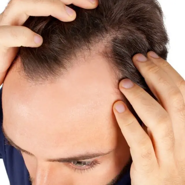 ¿Por qué se nos cae el cabello y cuándo debemos verlo como un alarmante signo de alopecia o una ...