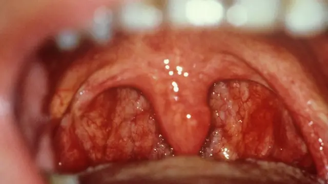gonorrhea in mouth and throat