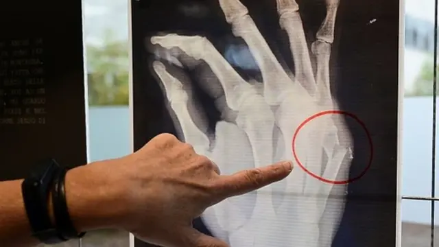 La sorprendente estrategia para curar mejor las fracturas (y no se ...