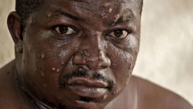 एमपॉक्स से जूझ रहा एक देश और मरीज़ों की आपबीती - BBC News हिंदी