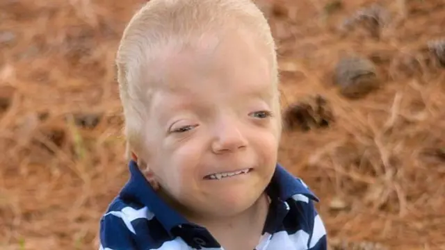 La madre que lucha contra los memes que se burlan de su hijo de 3 años gravemente enfermo - BBC ...