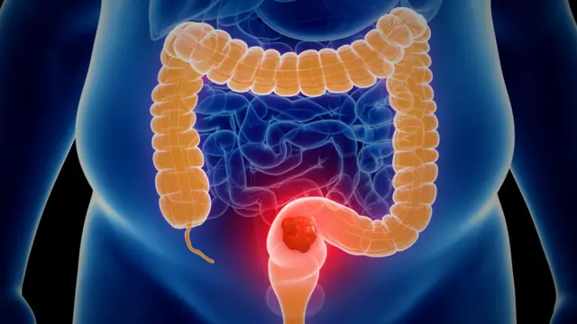 3 causas de la sangre en las heces (que no son cáncer de colon) - BBC ...