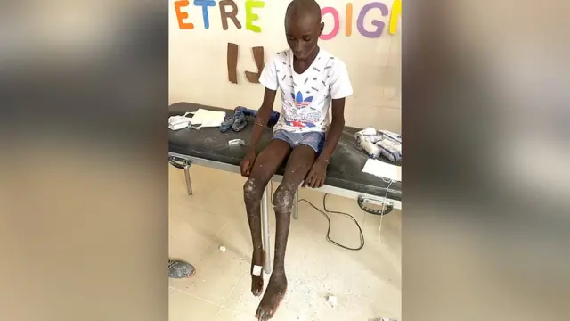 Clubfoot: Treatment wey dey change life of Senegalese pipo di condition ...