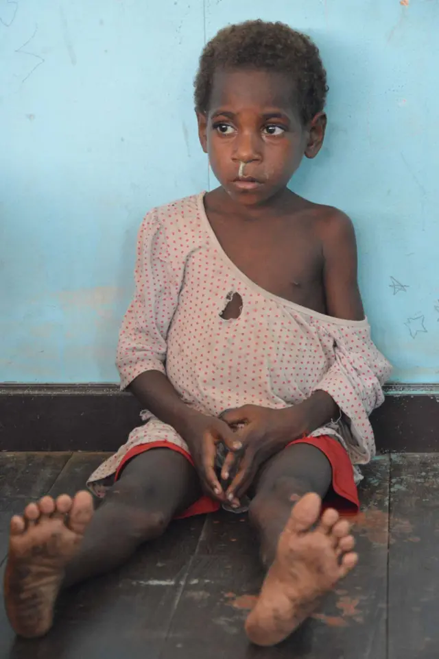 Papua: Mengapa gizi buruk masih menghantui Asmat? - Cerita dari kampung terpencil di pedalaman ...