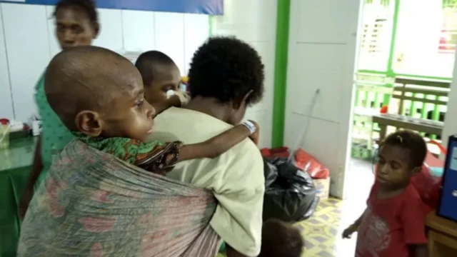 Papua: Mengapa gizi buruk masih menghantui Asmat? - Cerita dari kampung terpencil di pedalaman ...