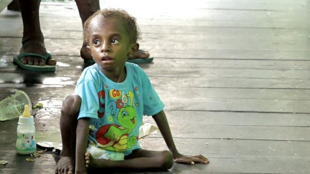 Melihat anak-anak di Asmat yang dilanda wabah campak dan gizi buruk - BBC News Indonesia