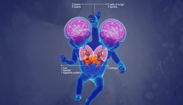 Soeurs siamoises sénégalaises : Les jumelles Marième et Ndèye survivent ...