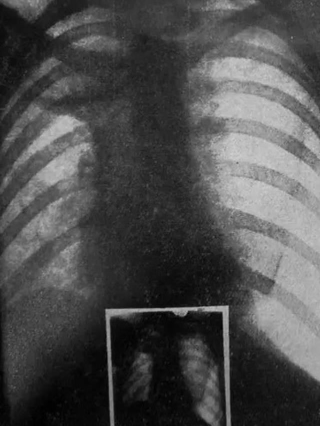 Tuberculose : l'invention qui a révolutionné le traitement de la ...