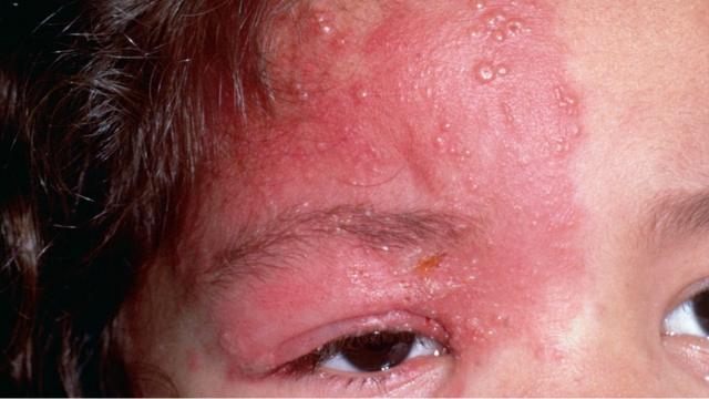 హెర్పెస్ జోస్టర్ లేక షింగిల్స్: శరీరం మీద ఆ గుల్లలు ఎందుకు వస్తాయి ...