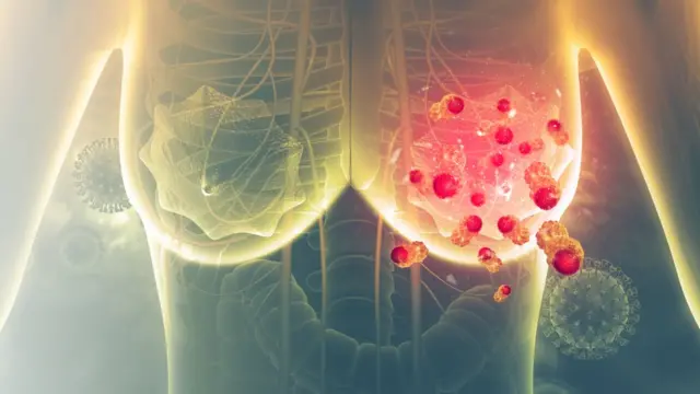 Qué es el cáncer de mama metastásico y cómo puedes reconocer sus ...