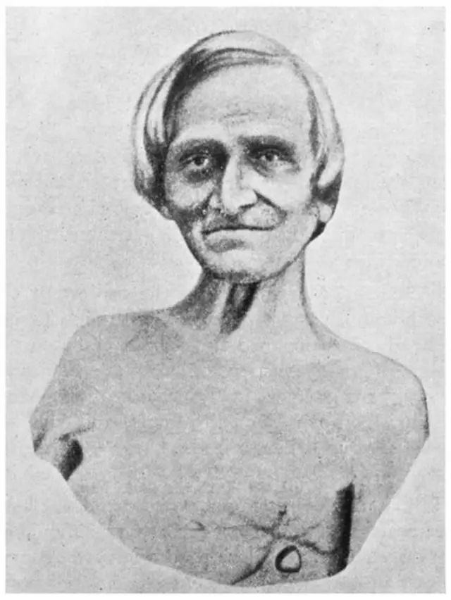 Alexis St. Martin, el hombre con un agujero en el cuerpo que le ...