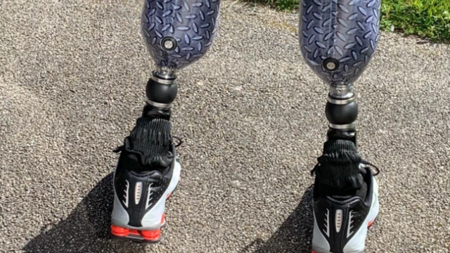 "Odio decirlo, pero desde que perdí mis piernas tengo una vida más ...