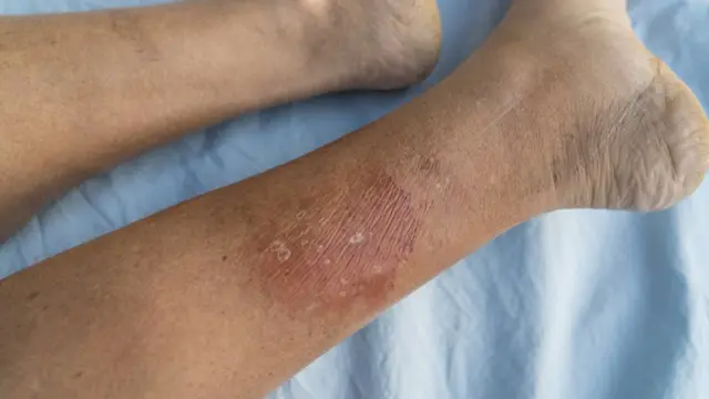 O que é erisipela, problema que afeta a perna de Bolsonaro? - BBC News Brasil