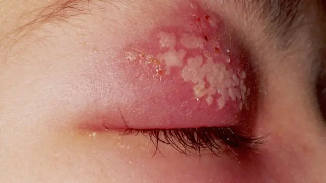 Herpes neonatal: el "beso de la muerte" que casi le cuesta la vida a mi ...