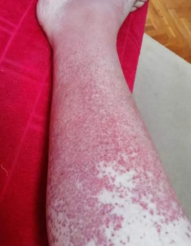 Srbija i zdravlje: Šta je lupus i kako se leči - BBC News na srpskom