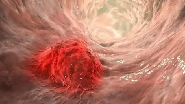 Cancer colorectal : comment expliquer l'augmentation du nombre de cas ...