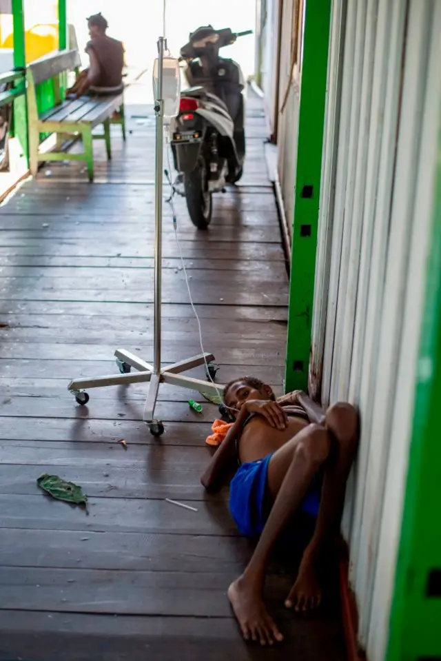 Papua: Mengapa gizi buruk masih menghantui Asmat? - Cerita dari kampung terpencil di pedalaman ...