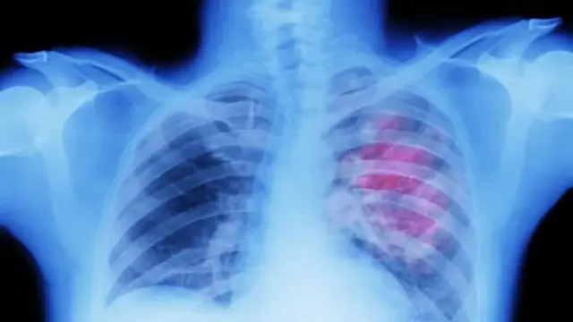 Dalili 10 za saratani ambazo hazitambuliwi kirahisi - BBC News Swahili