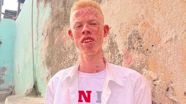 'Apedrejados na rua': a vida de pessoas albinas na Somália - BBC News ...
