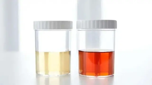 Kesehatan: Apa makna warna urine Anda, dari kuning, oranye, merah ...