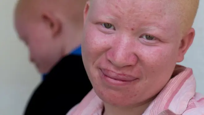 World Albinism Day: Gerald Uche Eke sọ ìrírí rẹ̀ gẹ́gẹ́ bí àfín àti ohun tó fà á tó ṣe ní àrun ...