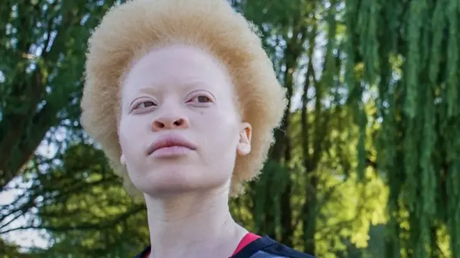World Albinism Day: Gerald Uche Eke sọ ìrírí rẹ̀ gẹ́gẹ́ bí àfín àti ohun tó fà á tó ṣe ní àrun ...