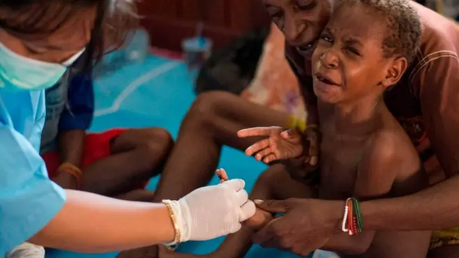 Setelah KLB polio, muncul KLB campak - Anak Indonesia berisiko terkena wadah ‘tumpang-tindih ...
